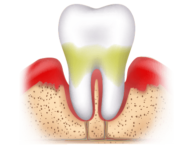 Parodontose: Symptome | Denta Expert